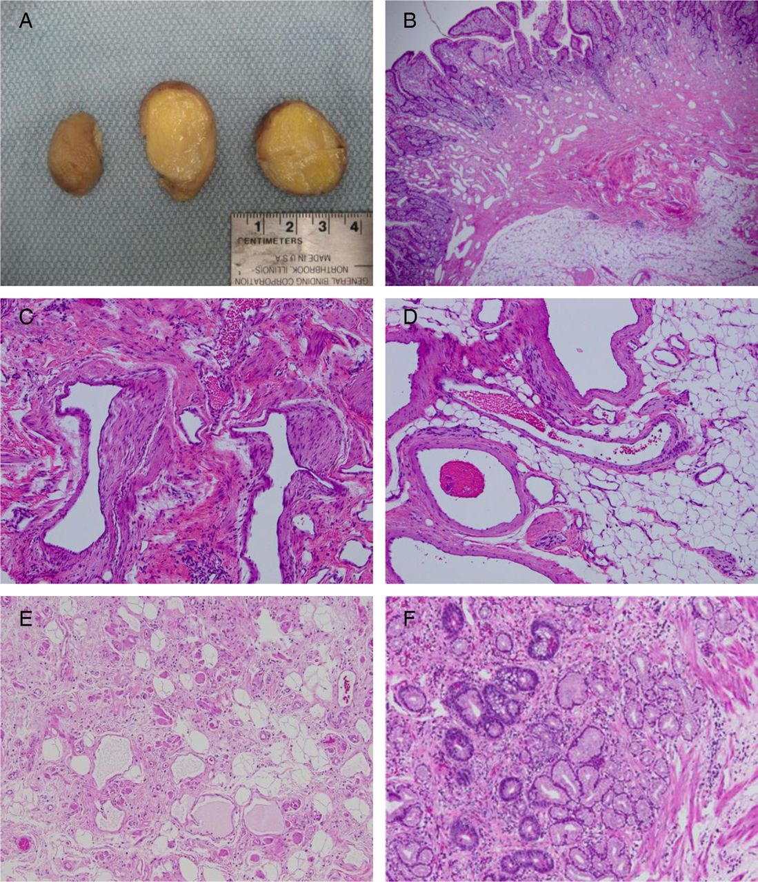 Neuromuscular and vascular hamartoma: is it a true hamartoma? | Journal ...