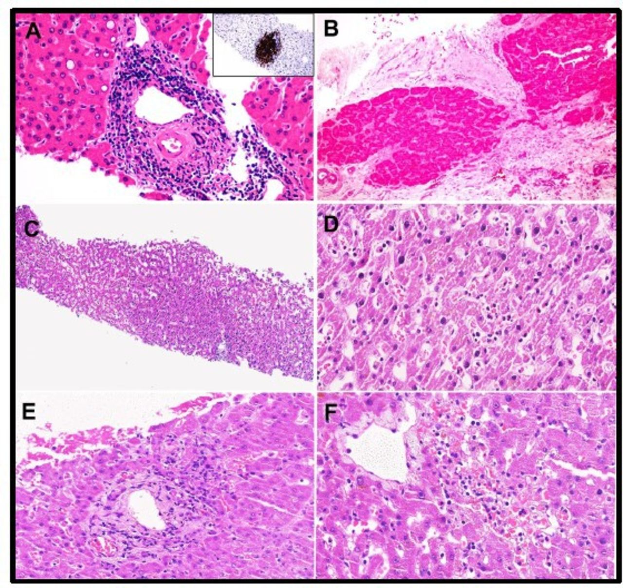 Histopathological Observations In COVID 19 A Systematic Review Histopathological Observations In COVID 19 A Systematic Review