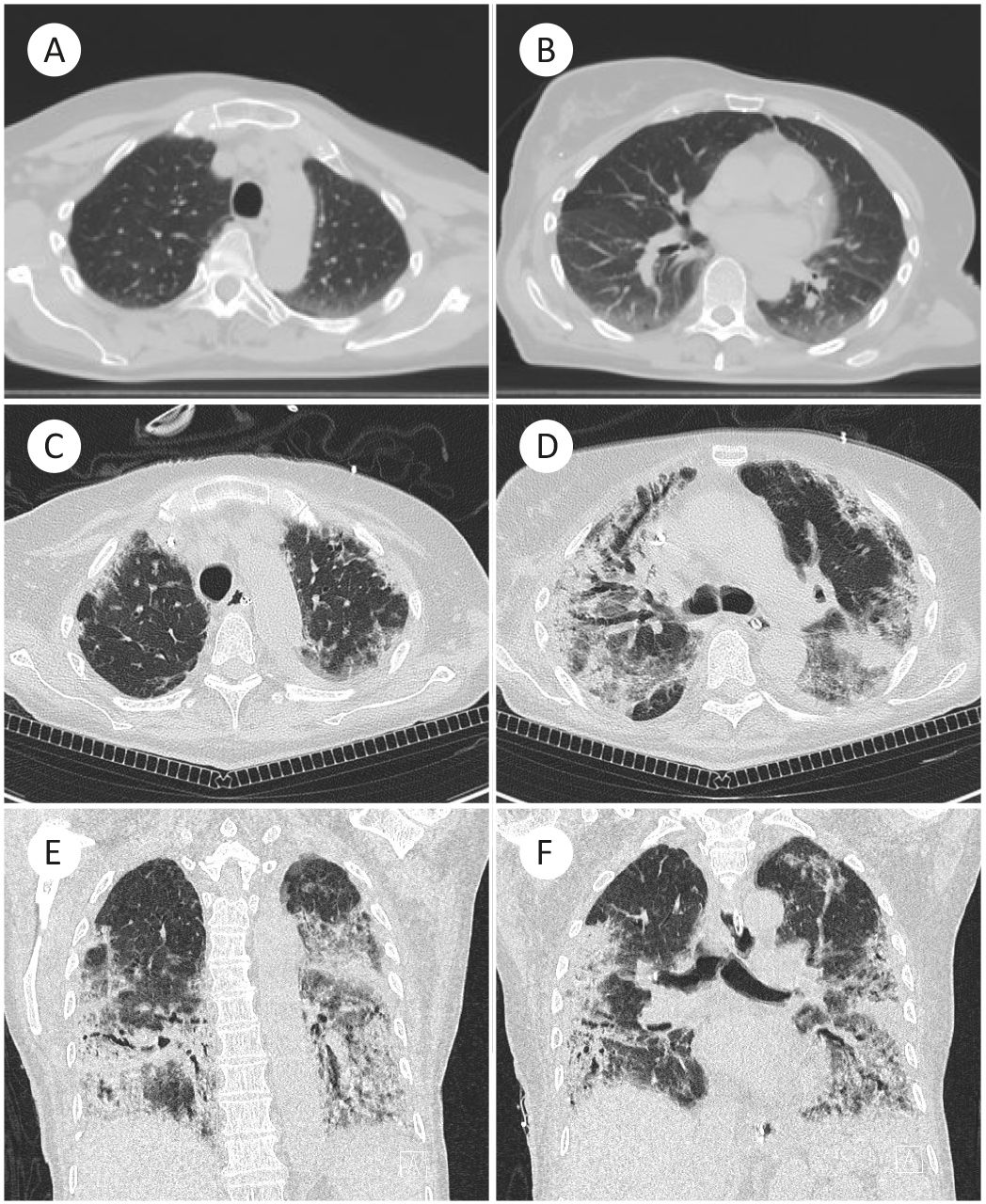Pulmonary Fibrosis Pulmonary Fibrosis
