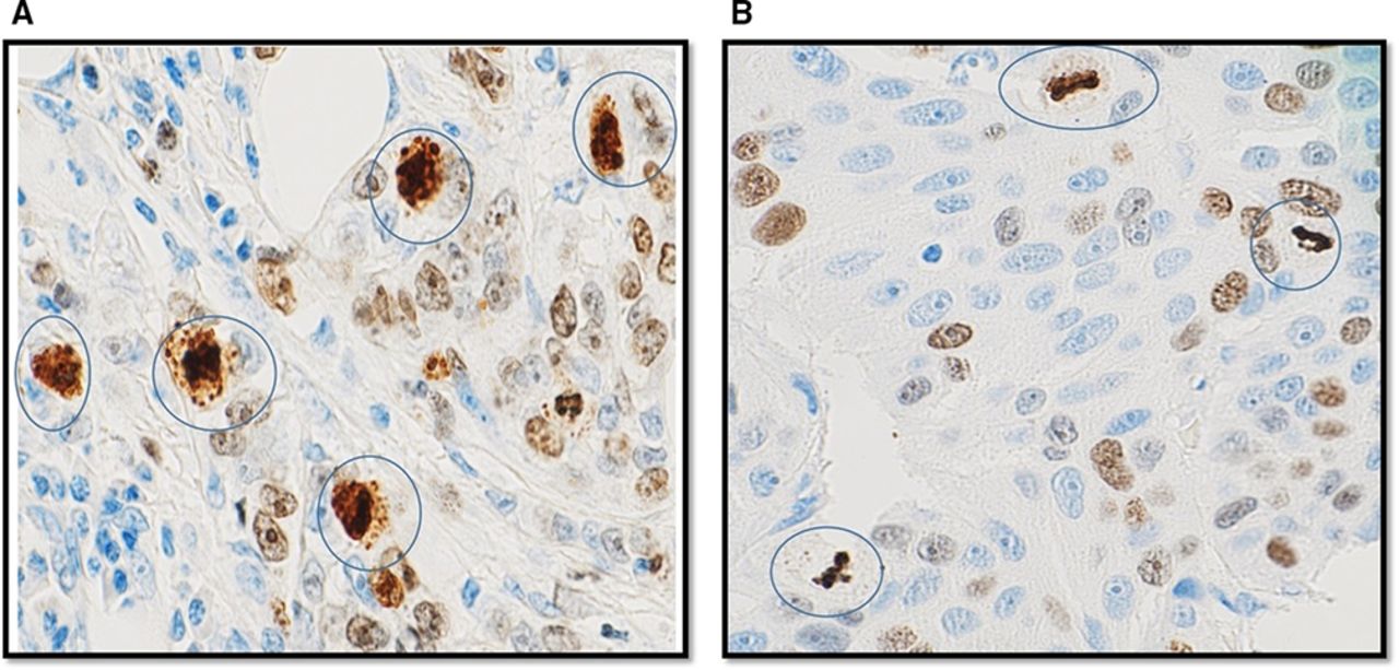 Expression, assessment and significance of Ki67 expression in breast ...