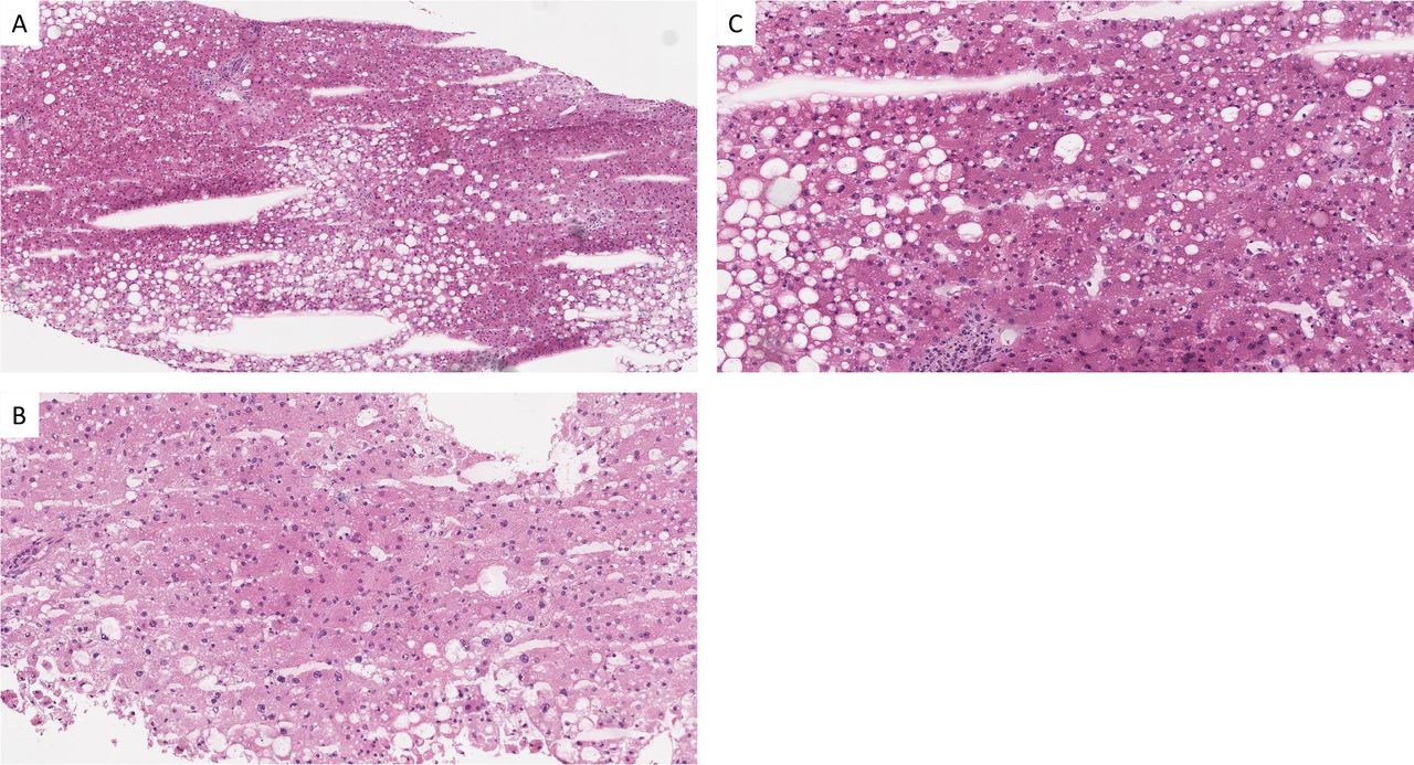 Assessment of large droplet fat in frozen sections of donor liver ...