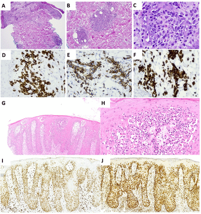The fifth edition of the WHO classification of mature T cell, NK cell ...