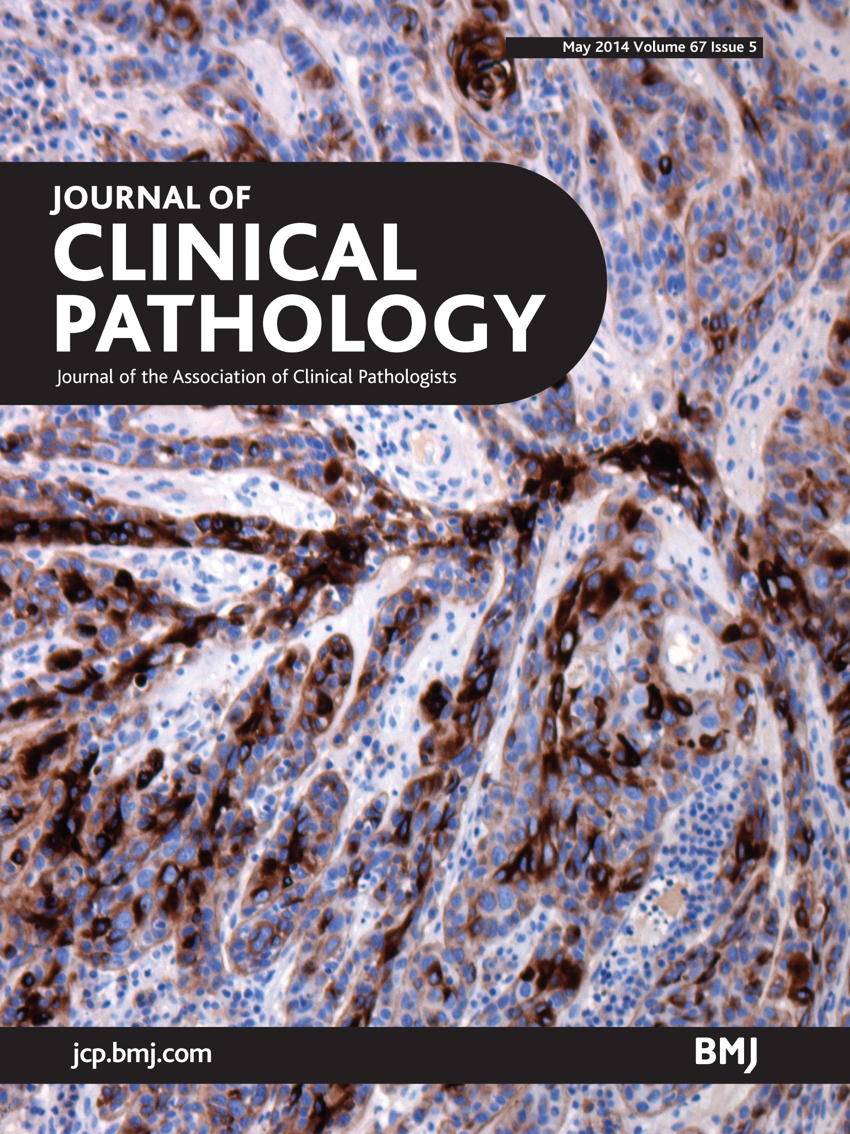 Bone marrow trephine biopsy involvement by lymphoma: review of ...