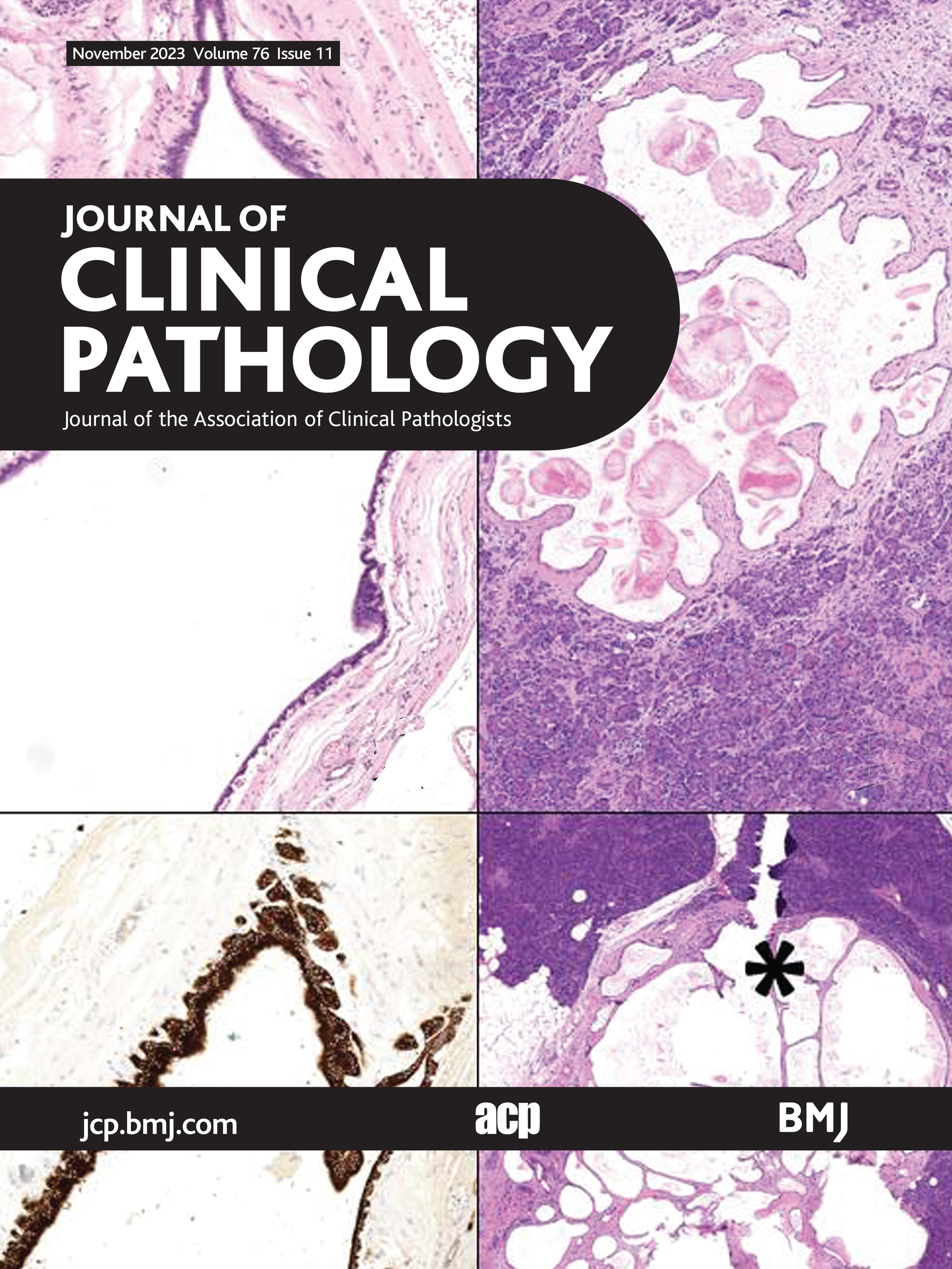 New kids on the block: FOS and FOSB gene | Journal of Clinical Pathology