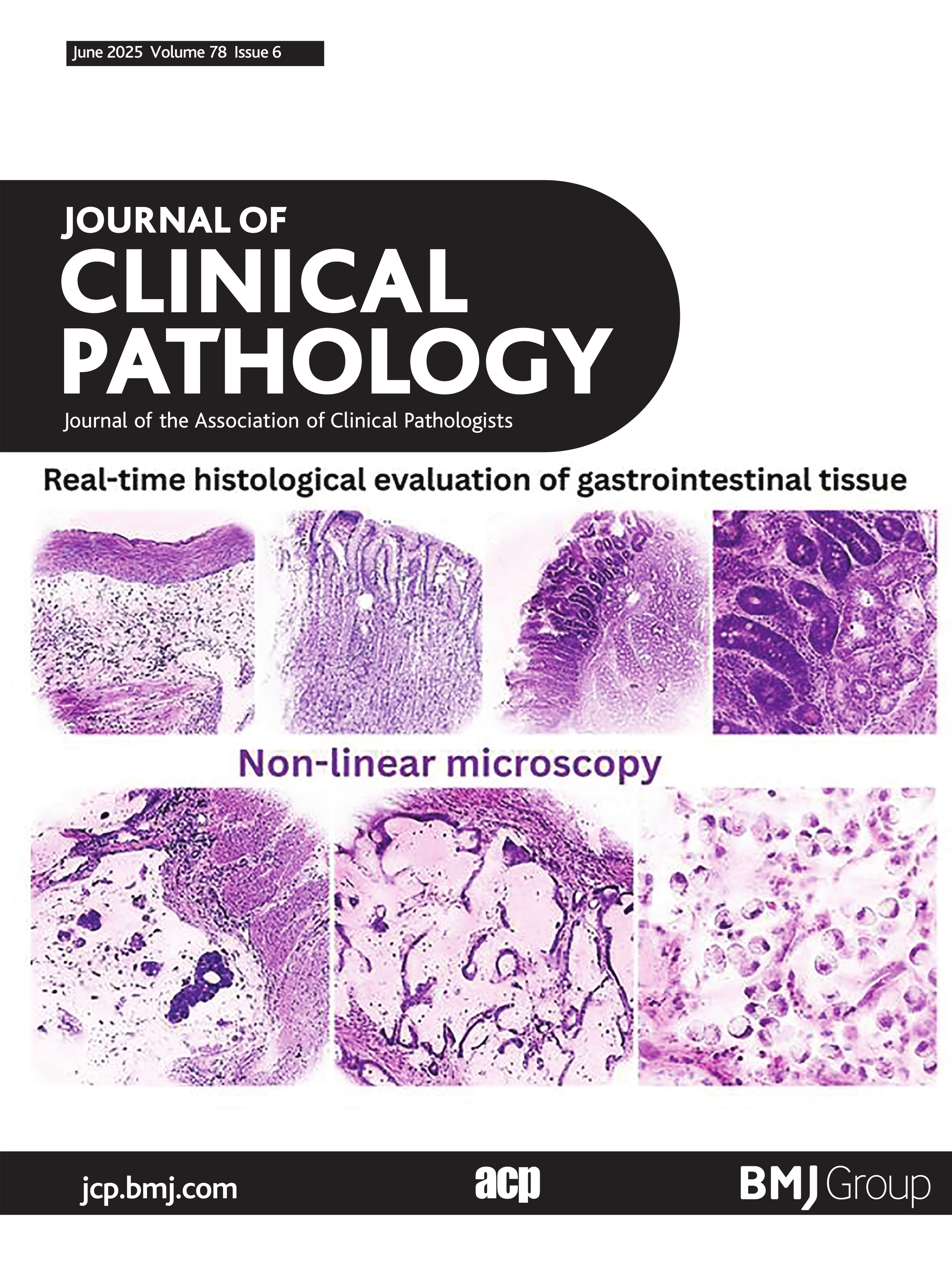 Re-evaluating the relevance of extensive intraductal component (EIC) in ...